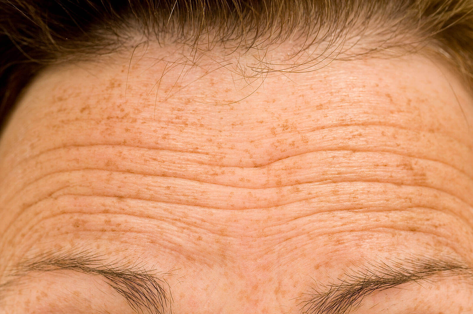 Plagued by sun damage and discolourations of the skin? Get help here!